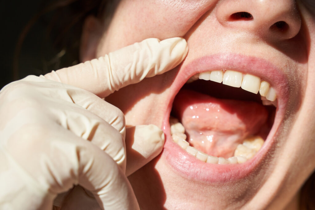 Why Does My Tongue Feel Like It’s Scalded? Understanding Burning Mouth ...